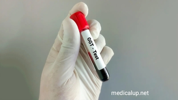 لماذا يُطلب إجراء تحليل GGT؟ وما تفسير نتائجه؟ – Medical Up